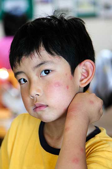 Alternative EarthCare Shares 6 Tips to Help Protect Kids from Mosquito ...